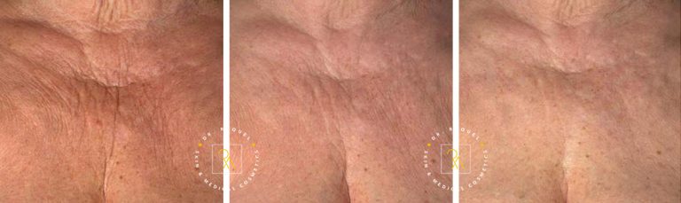 Radiesse: The Collagen-Boosting Secret for a Youthful Décolleté | Dr Raquel